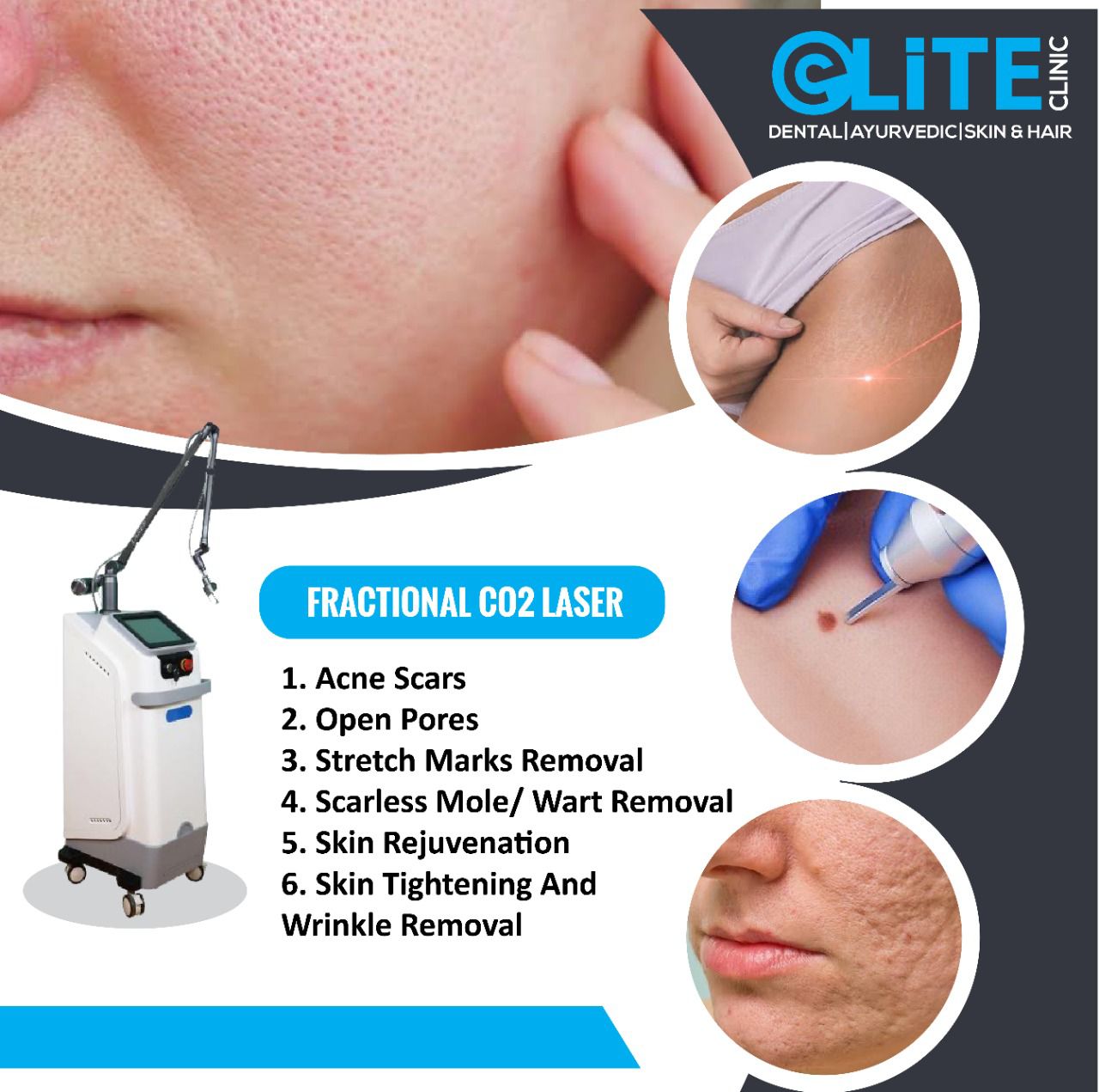 FRACTIONAL CO2 LASER Elite Clinic FRACTIONAL CO2 LASER Elite Clinic